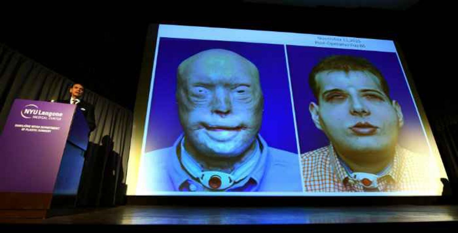 La greffe totale du visage la plus complète à ce jour vient d'être ...