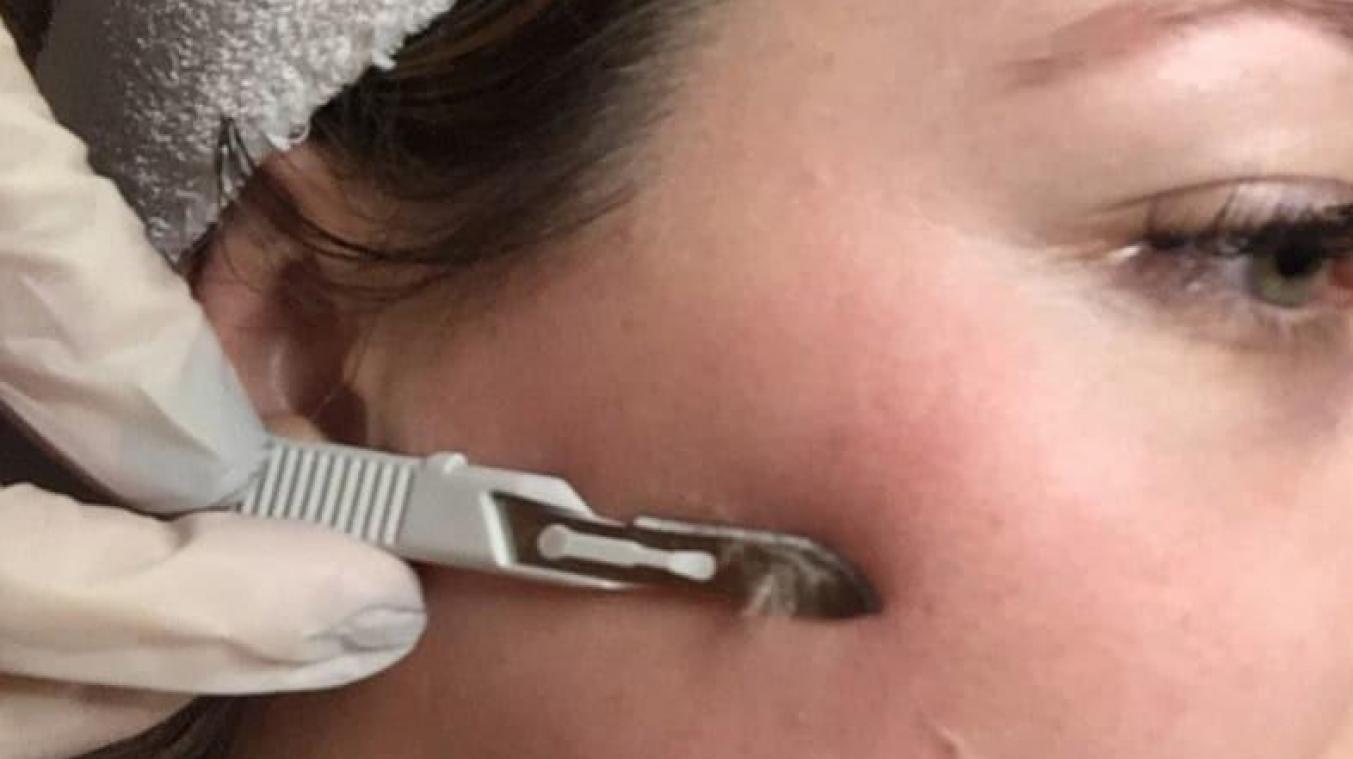 Qu’est-ce que le dermaplaning et peut-on utiliser cette technique à la ...